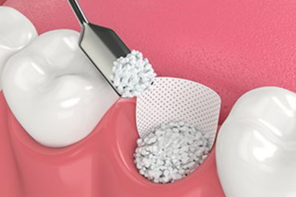 Bone Grafting - Adam R. Pershing, DMD