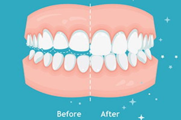 Bruxism - Adam R. Pershing, DMD