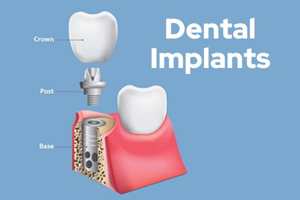 Dental Implant FAQs - Adam R. Pershing, DMD