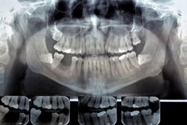 Digital X-Rays - Adam R. Pershing, DMD