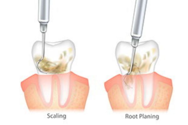 Non-Surgical Periodontal Procedures - Adam R. Pershing, DMD