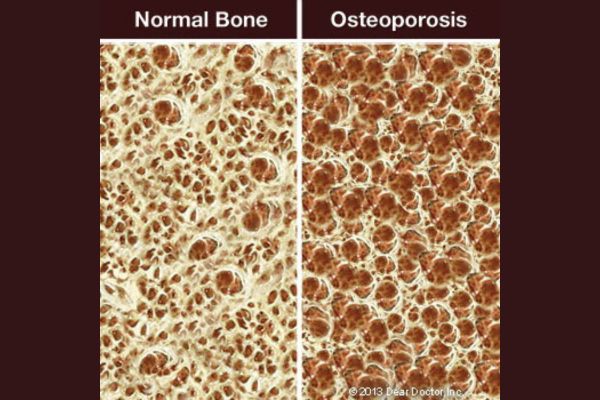 Osteoporosis & Oral Health - Adam R. Pershing, DMD