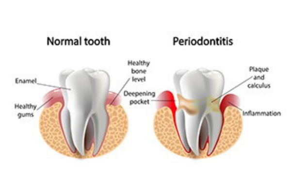 Periodontal Disease - Adam R. Pershing, DMD
