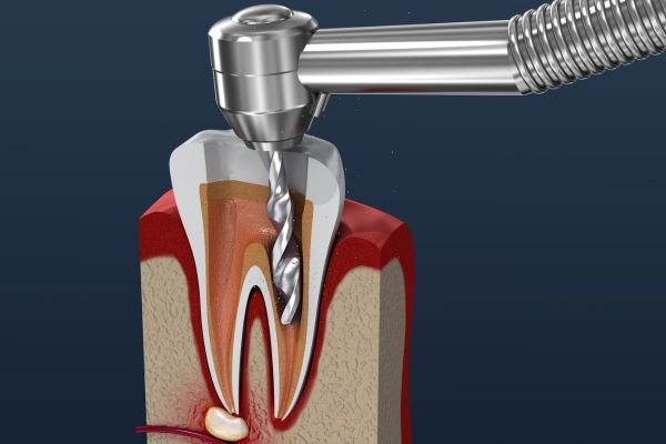 Root Canal Surgery (Apicoectomy) - Adam R. Pershing, DMD