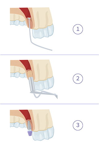 Sinus Surgery - Adam R. Pershing, DMD