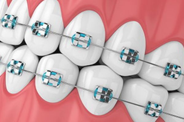 Types of Braces - Adam R. Pershing, DMD