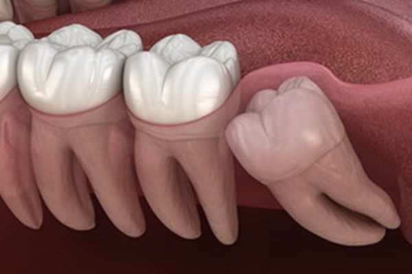 Wisdom Teeth Removal - Adam R. Pershing, DMD